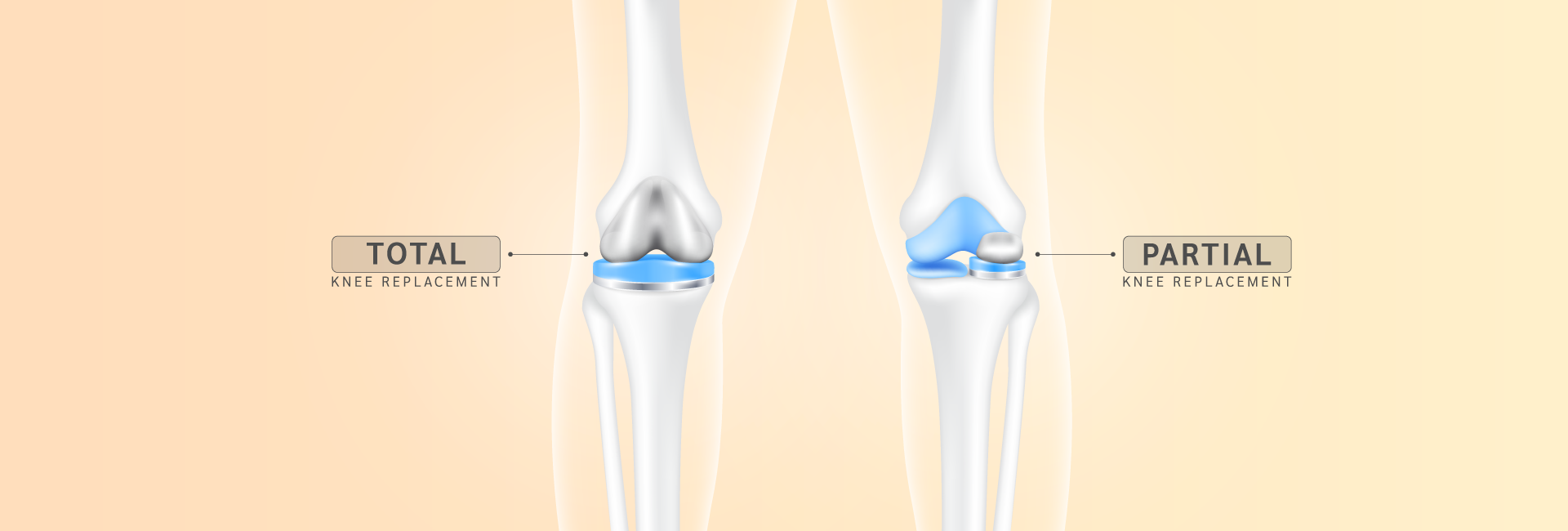 Different knee replacement surgeries: partial, total, and revision ...