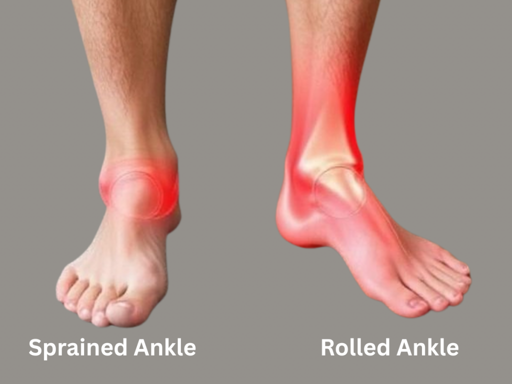 Sprained vs. Rolled Ankle: Differences & Treatments | SBJI